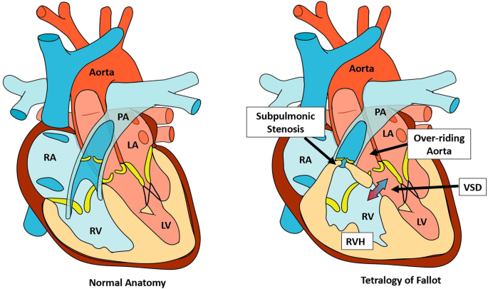 Preparing for Tetralogy of Fallot Repair: What to Expect ...