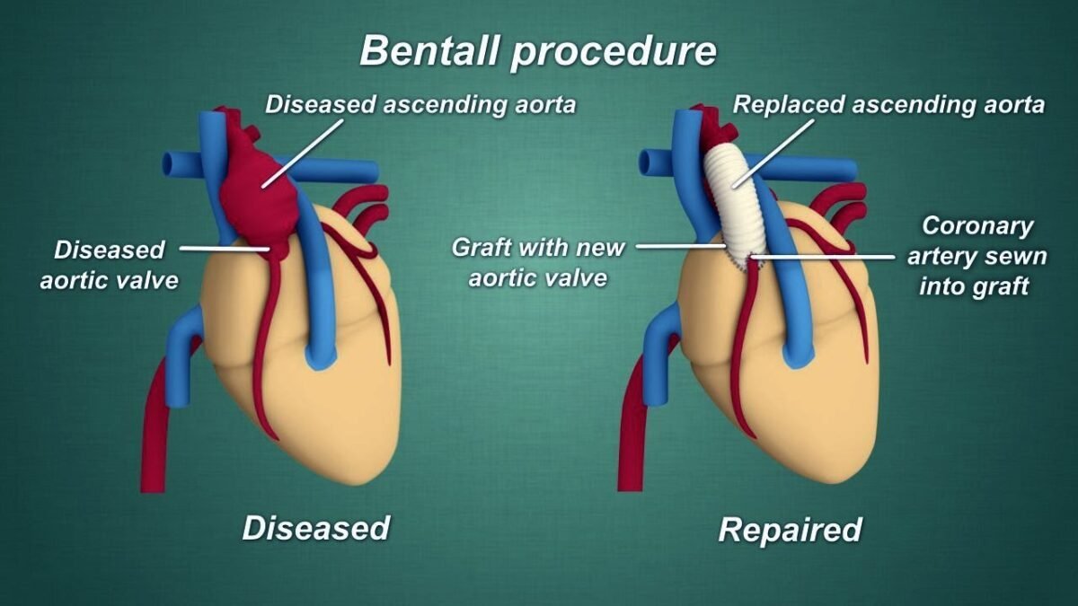 What is Bentall Surgery, and How Does it Address Heart Conditions? - Dr ...