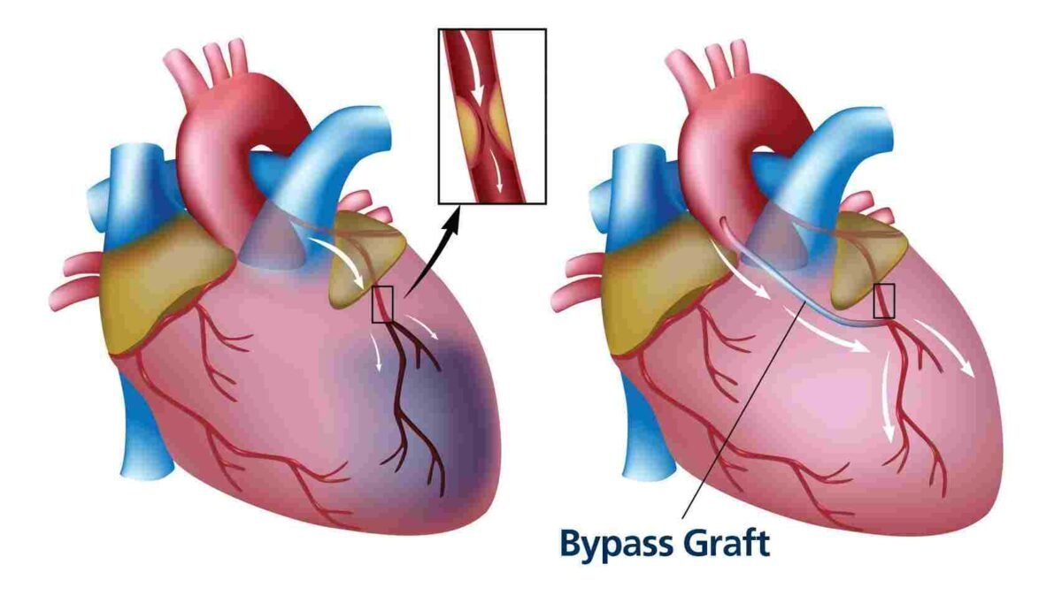 What Patients Must Know Before a Bypass Surgery? - drdineshkumarmittal.com